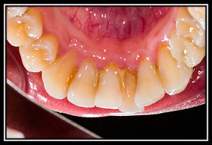 Dental Plaque | Homeland Ave Dental